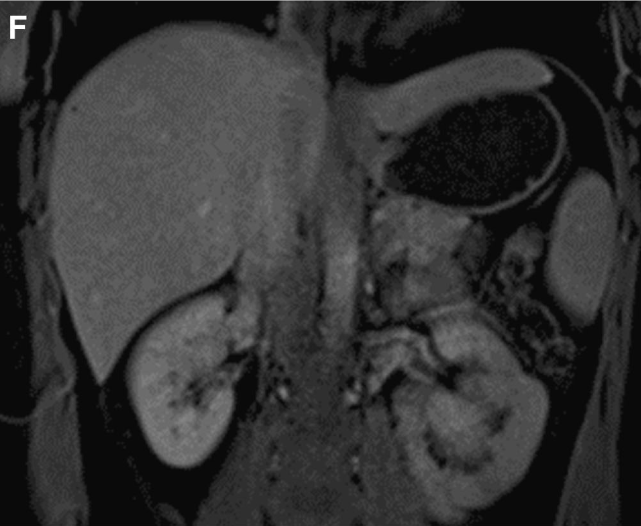 Fitz-Hugh-Curtis症候群の画像所見は？